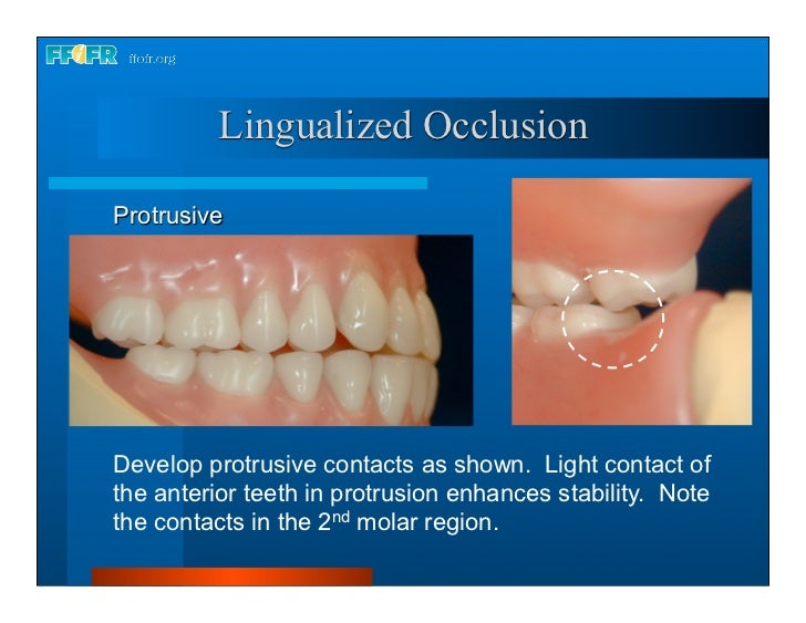 Complete dentures 16.occlusal schemes lingualized occlusion