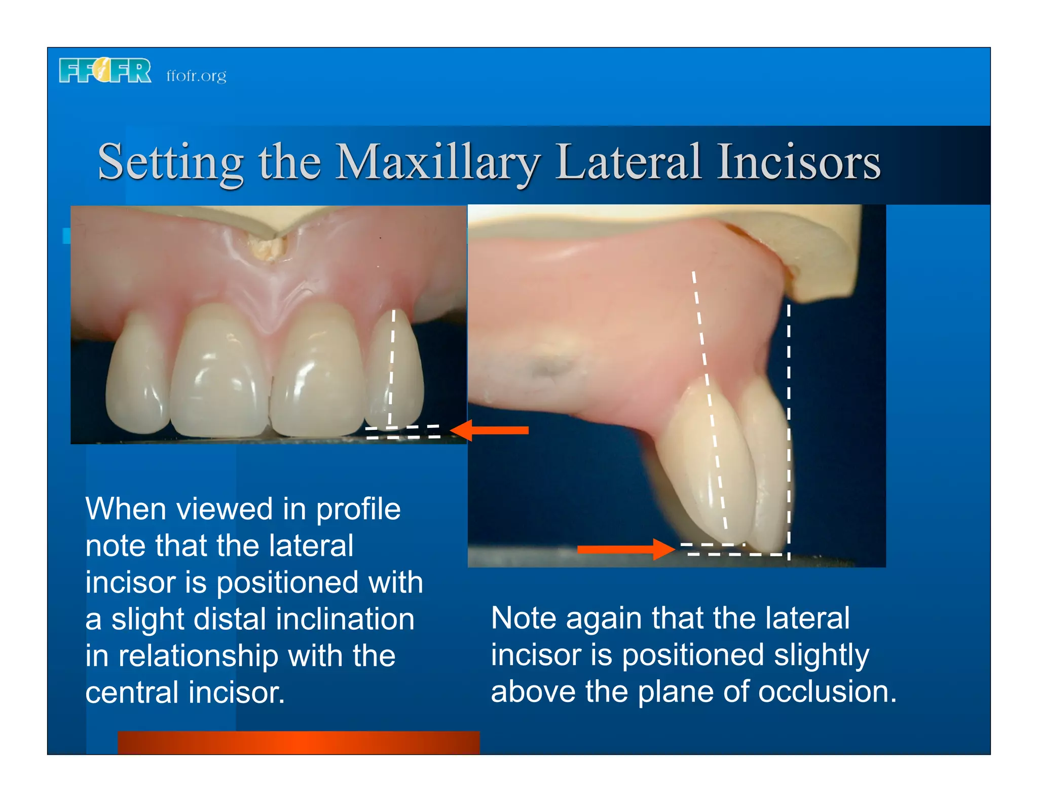 Complete dentures 16.occlusal schemes lingualized occlusion | PPT