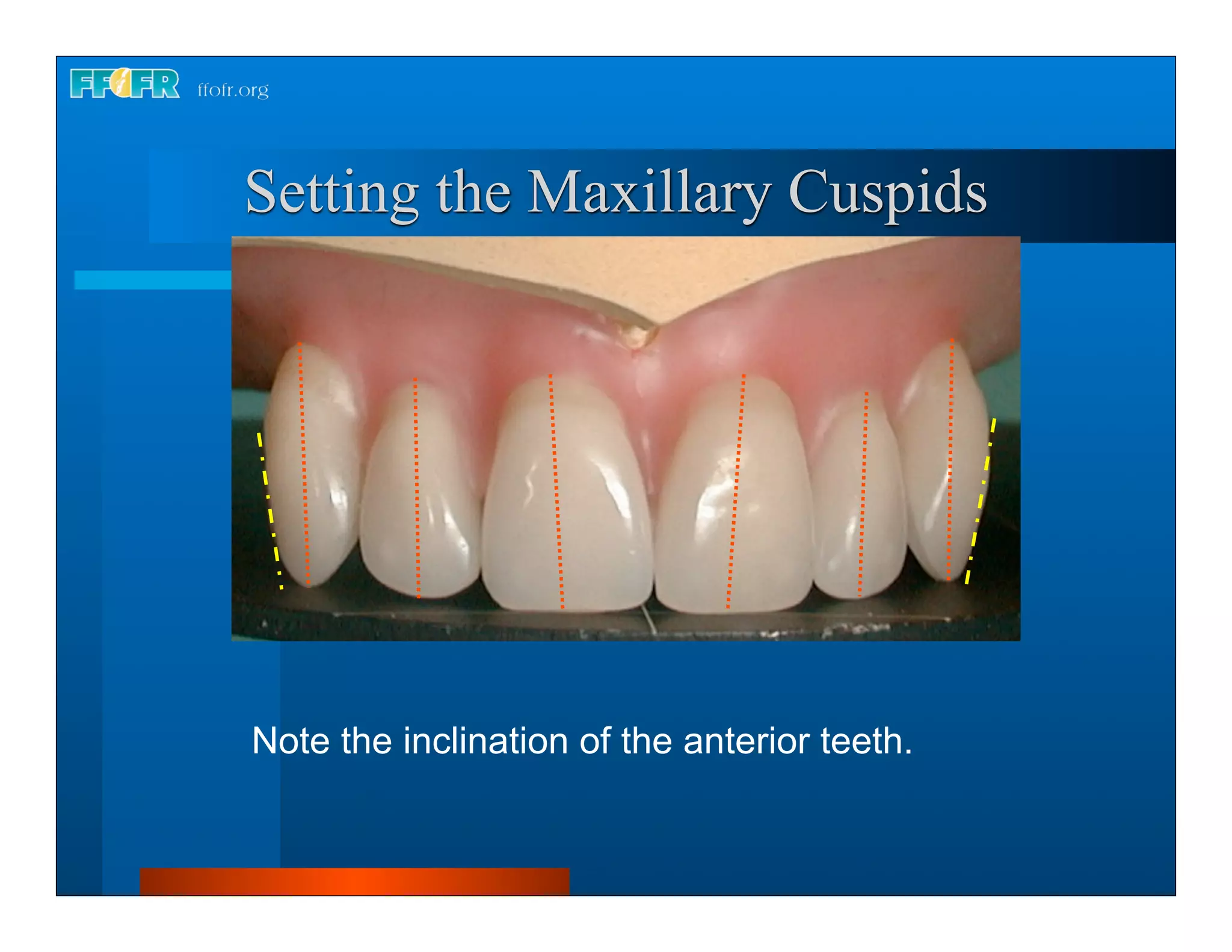 Complete dentures 16.occlusal schemes lingualized occlusion | PDF