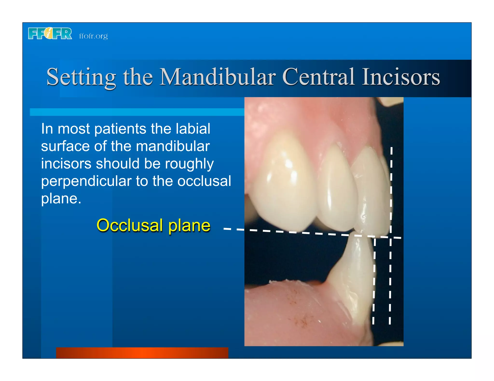 Complete dentures 16.occlusal schemes lingualized occlusion | PPT