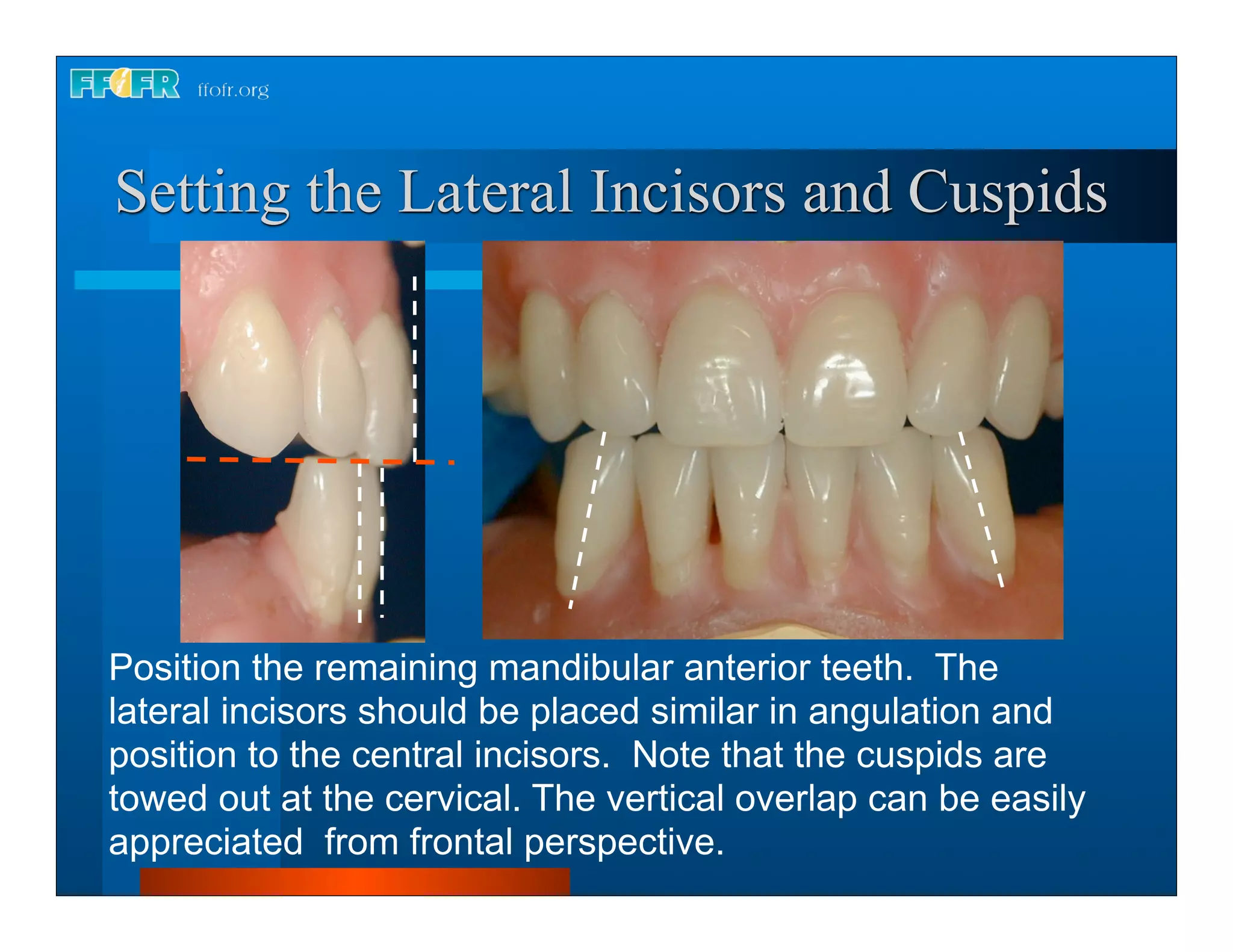 Complete dentures 16.occlusal schemes lingualized occlusion | PPT