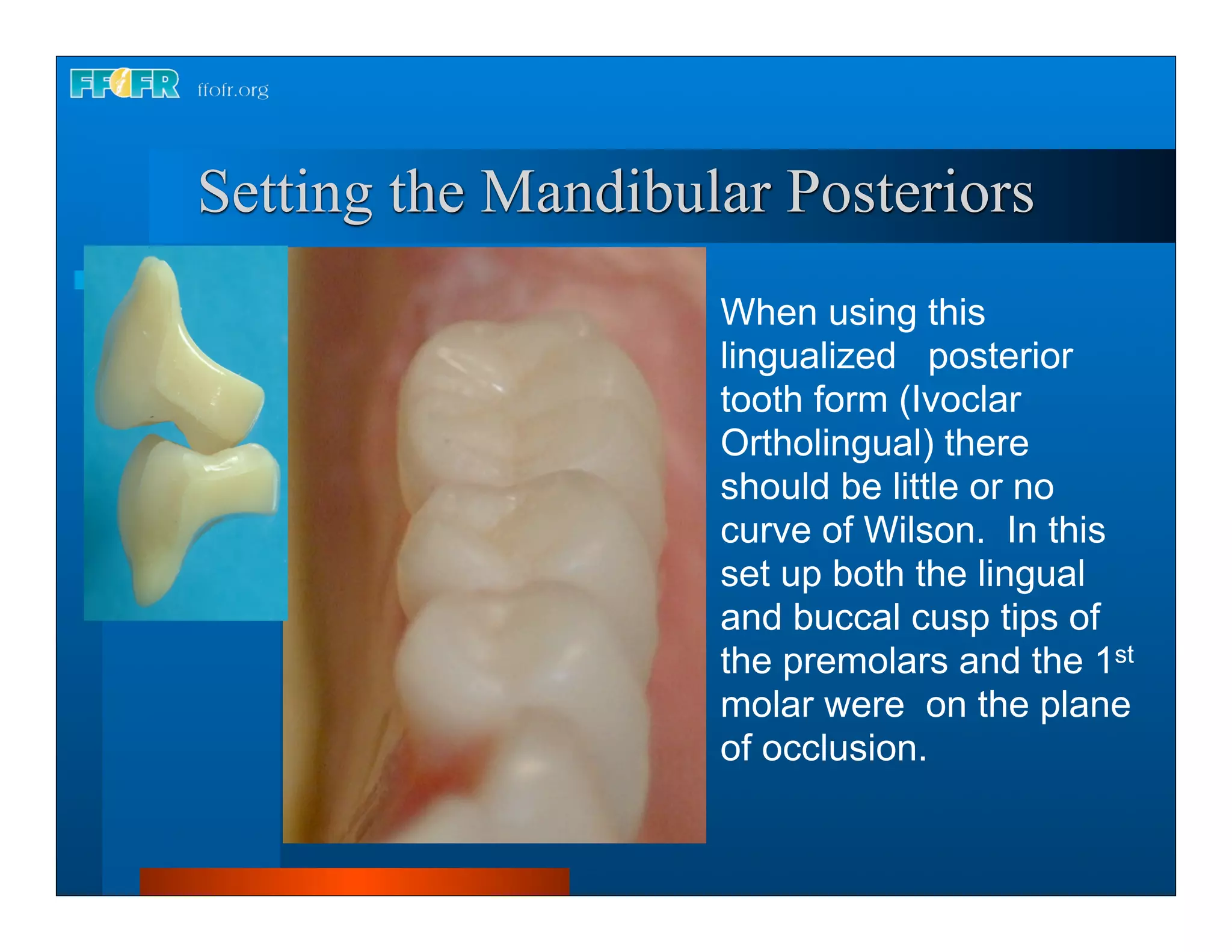 Complete dentures 16.occlusal schemes lingualized occlusion | PDF