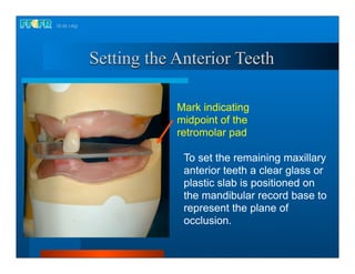 Complete dentures 16.occlusal schemes lingualized occlusion | PDF