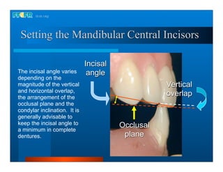 Complete dentures 16.occlusal schemes lingualized occlusion | PDF