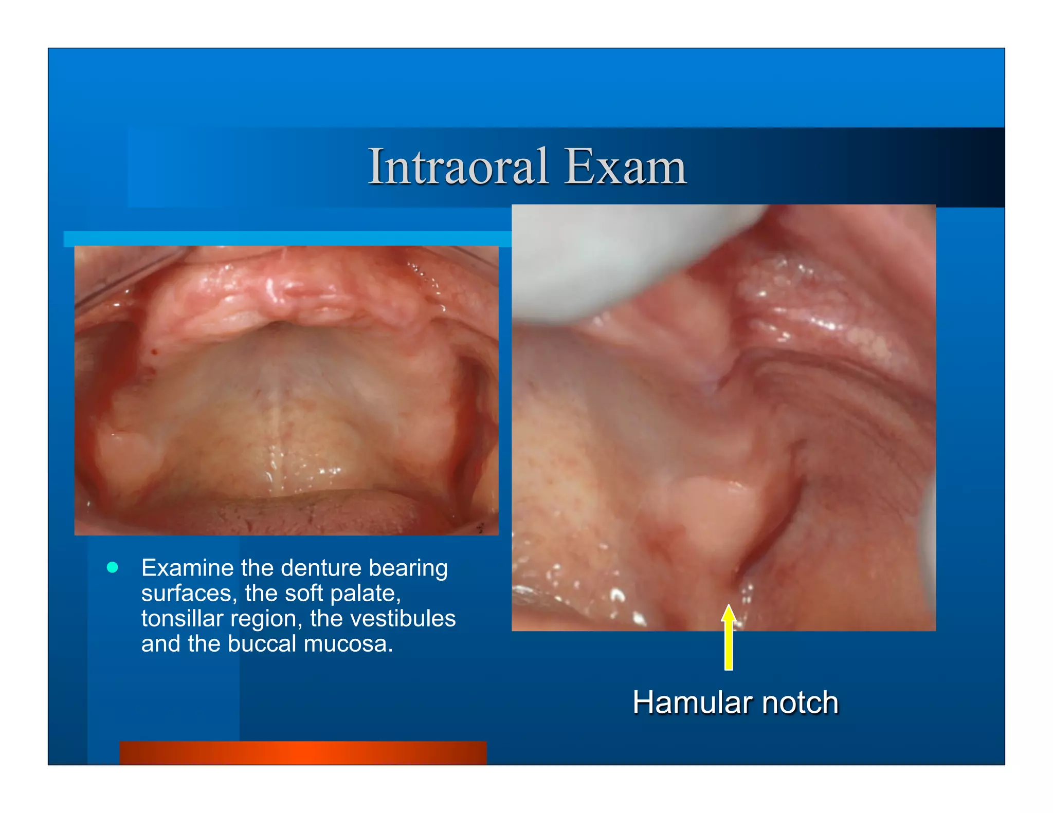 Complete dentures 3.history and exam | PDF