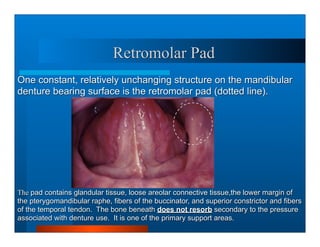 Retromolar Pad