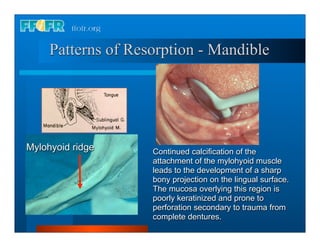 Mylohyoid Ridge Denture