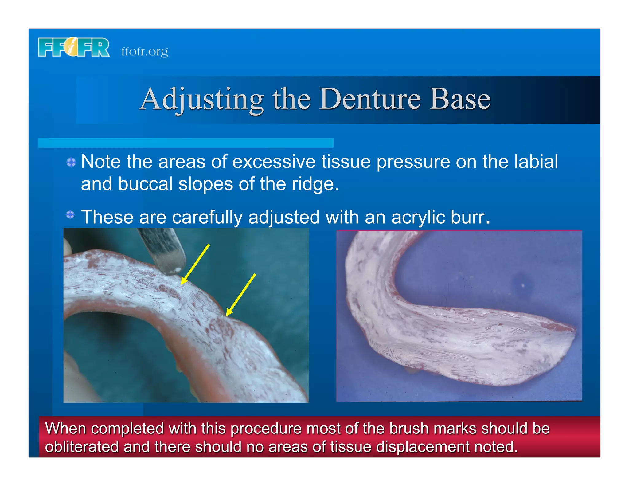 Complete dentures 30. insertion and followup | PDF