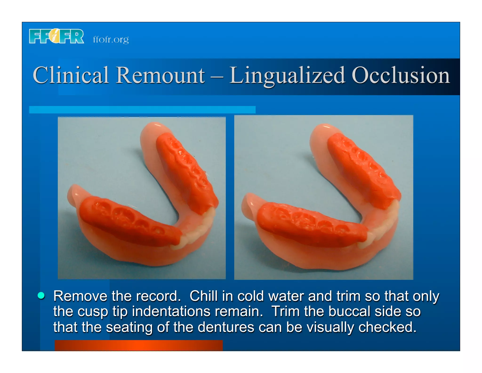 Complete dentures 30. insertion and followup | PDF