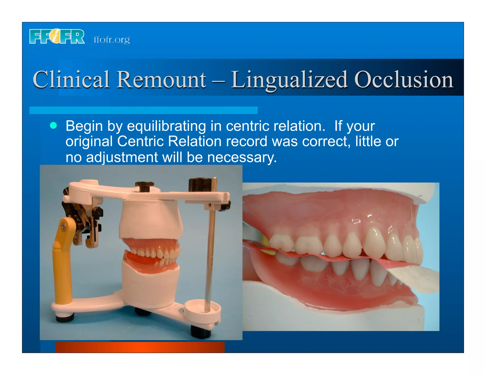 Complete dentures 30. insertion and followup | PDF