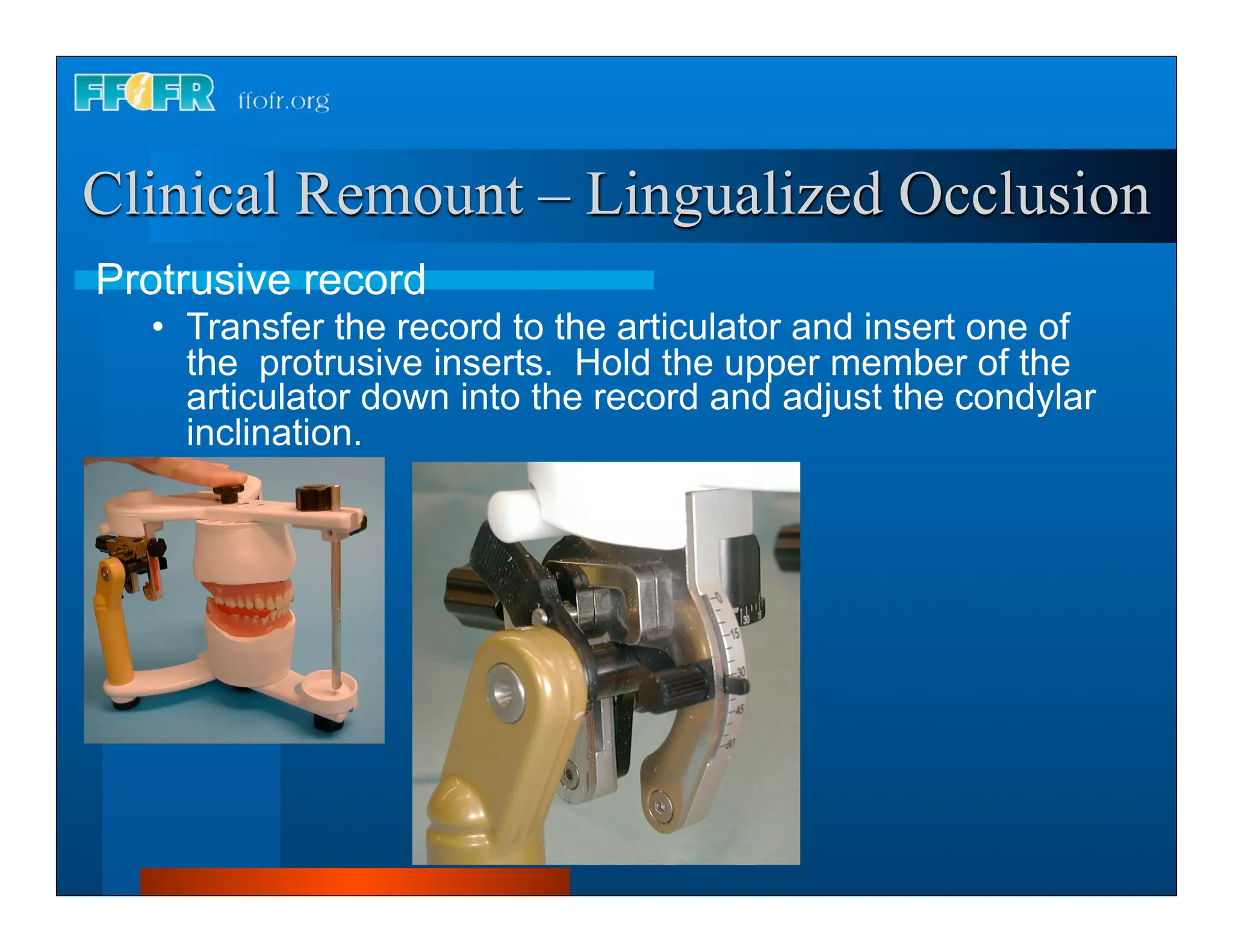 Complete dentures 30. insertion and followup | PDF