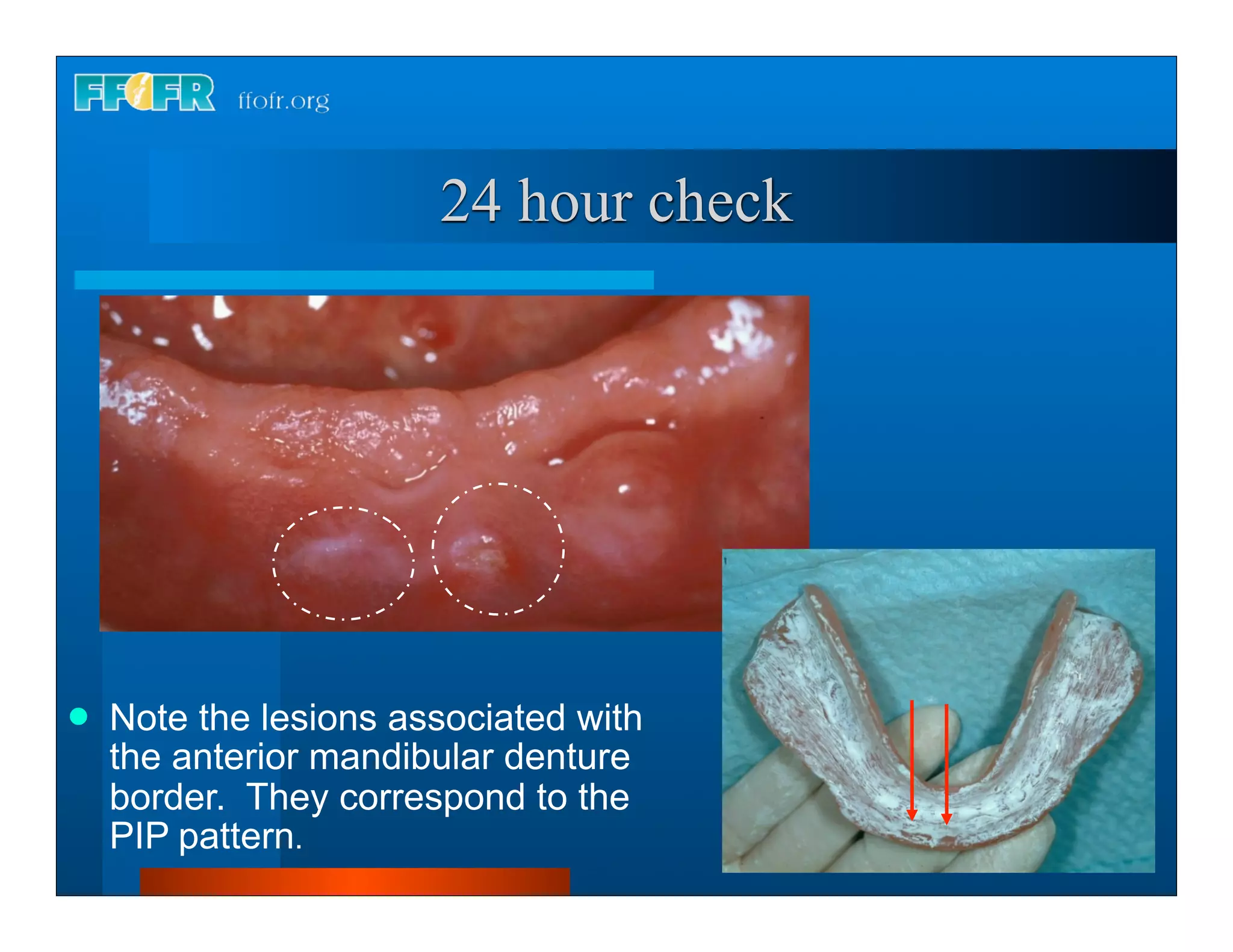 Complete dentures 30. insertion and followup | PDF
