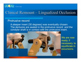 Complete dentures 30. insertion and followup | PDF