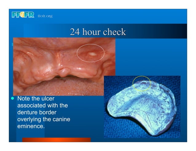 Complete dentures 30. insertion and followup | PDF