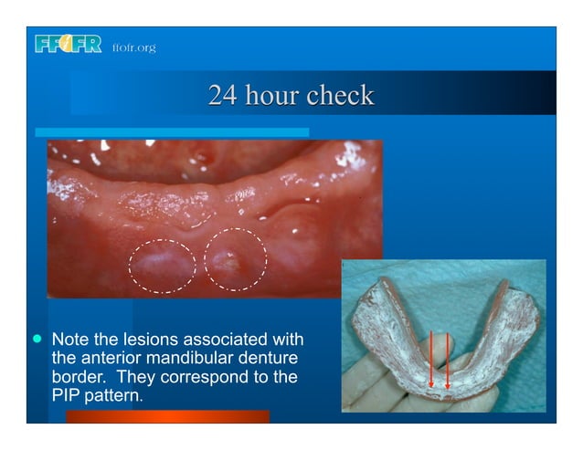 Complete dentures 30. insertion and followup | PDF