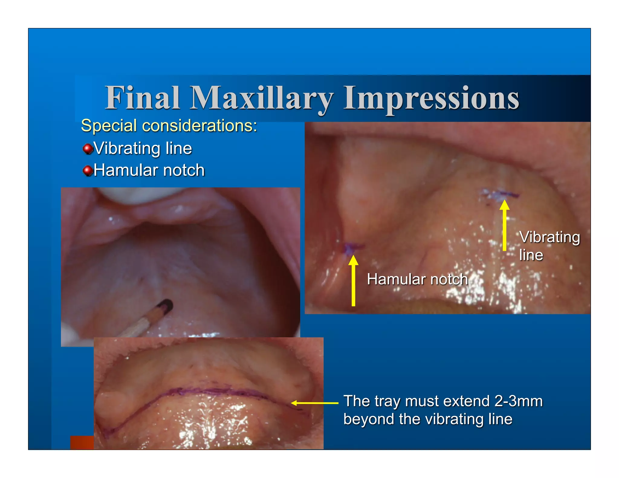 Complete dentures 7. final impressions | PDF