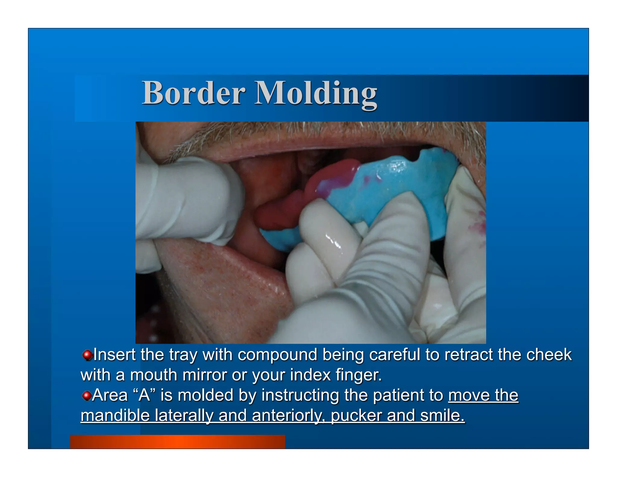 Complete dentures 7. final impressions | PDF