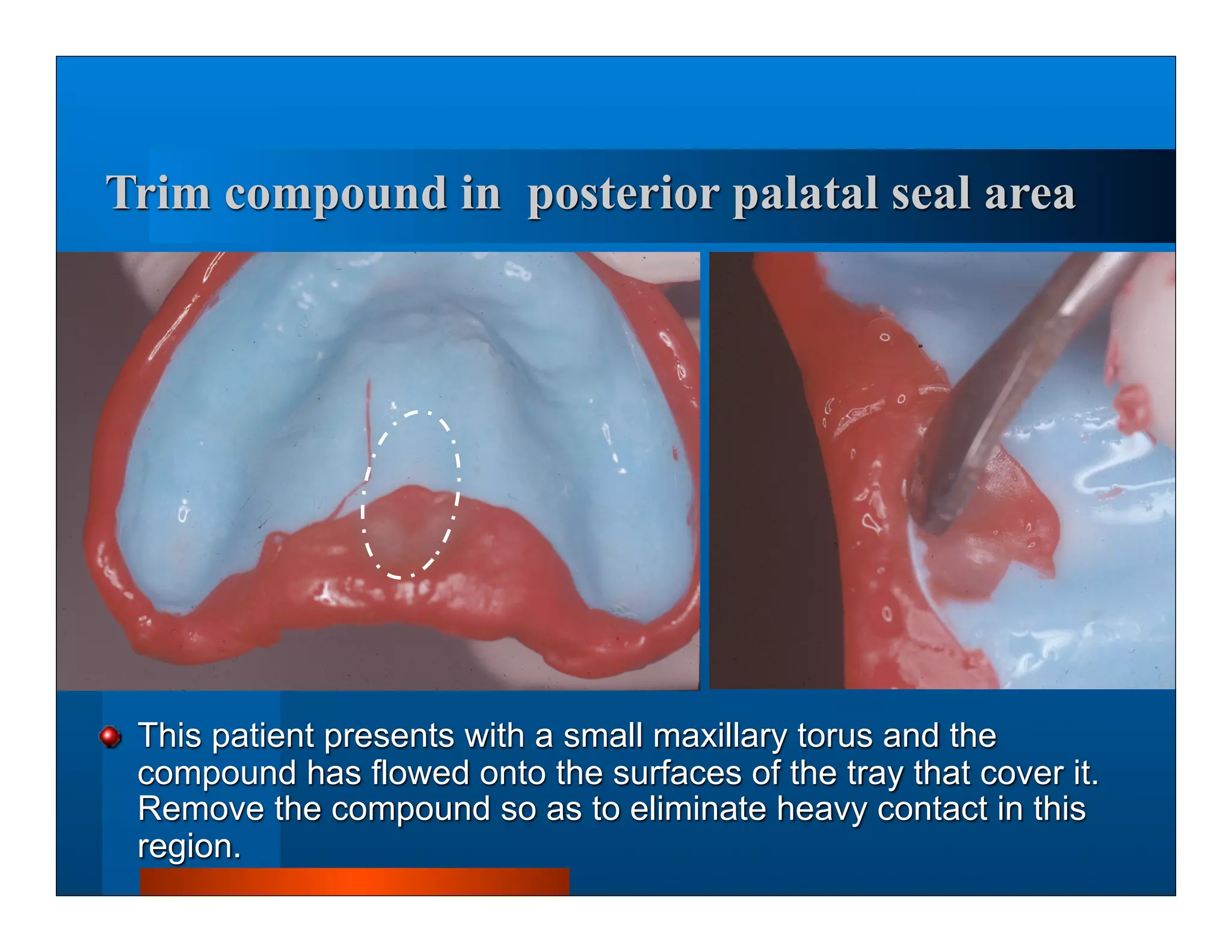 Complete dentures 7. final impressions | PDF