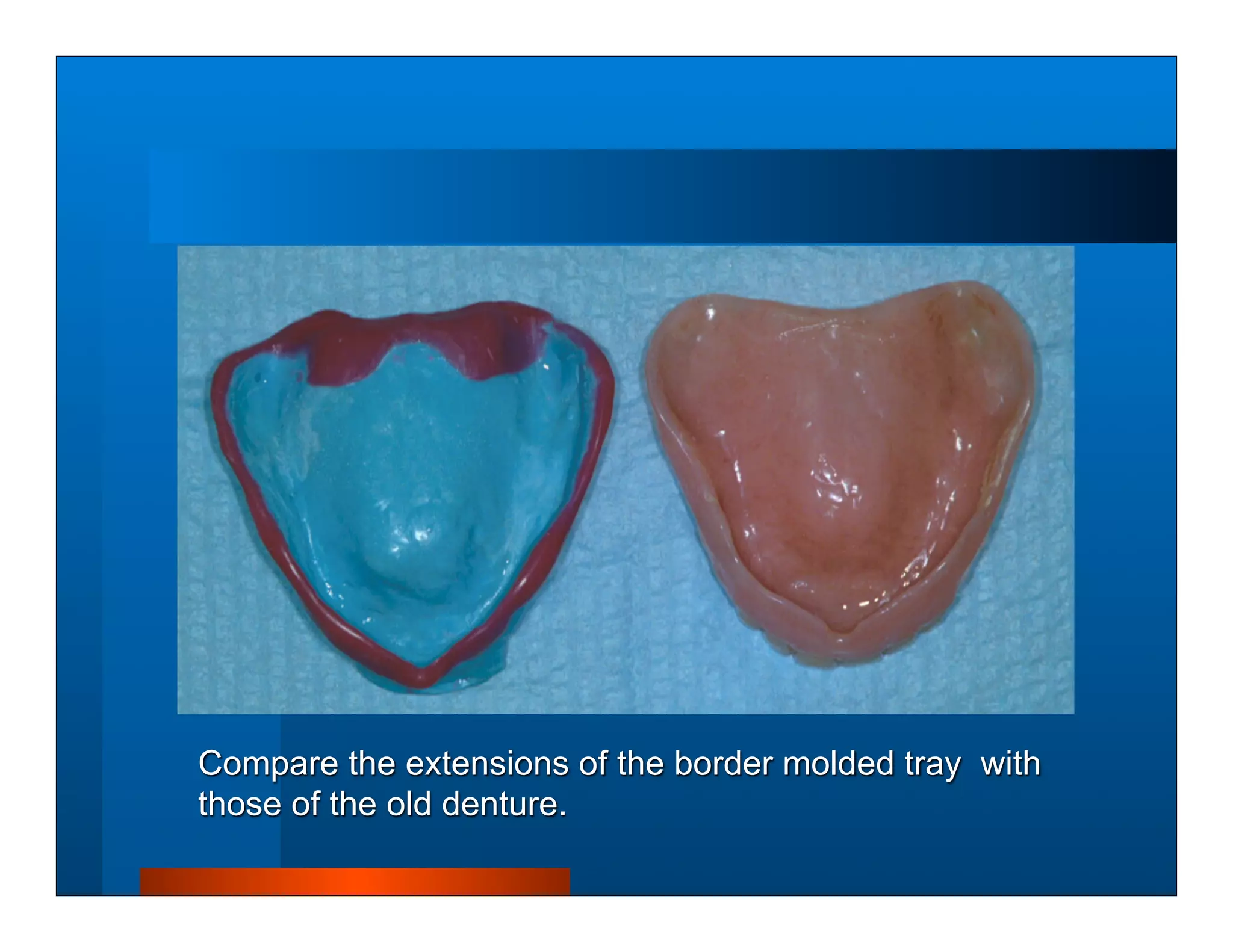 Complete dentures 7. final impressions | PDF