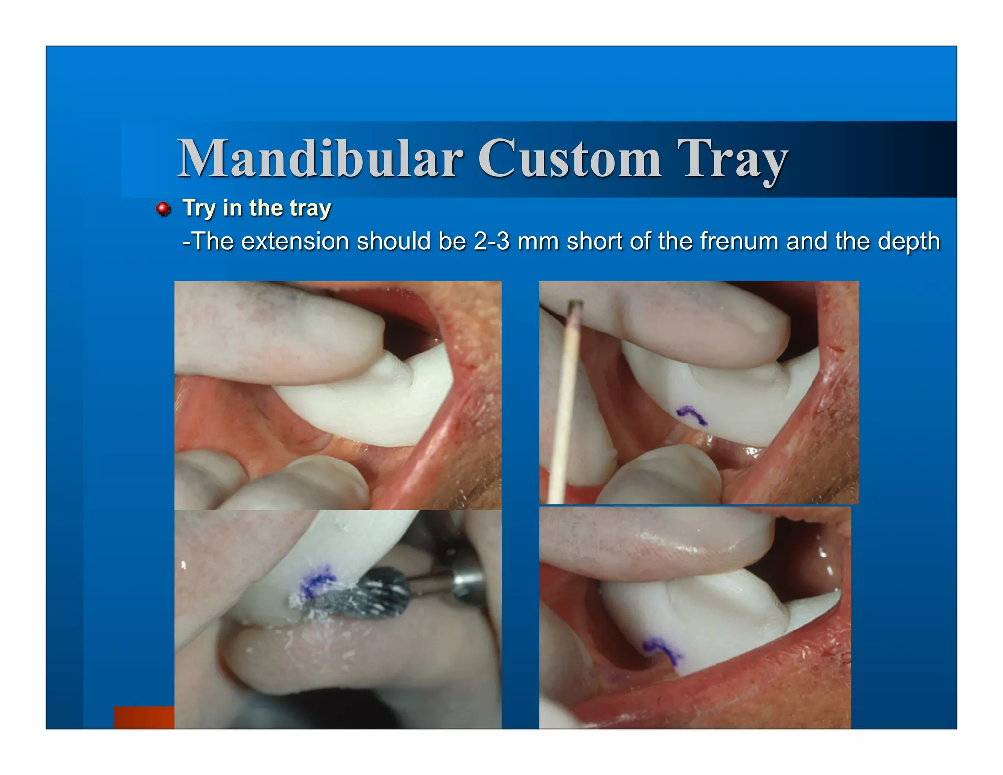 Complete dentures 7. final impressions | PDF