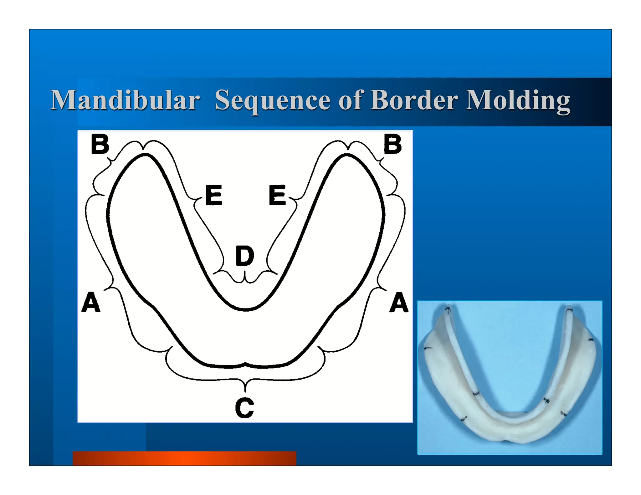 Complete dentures 7. final impressions | PDF