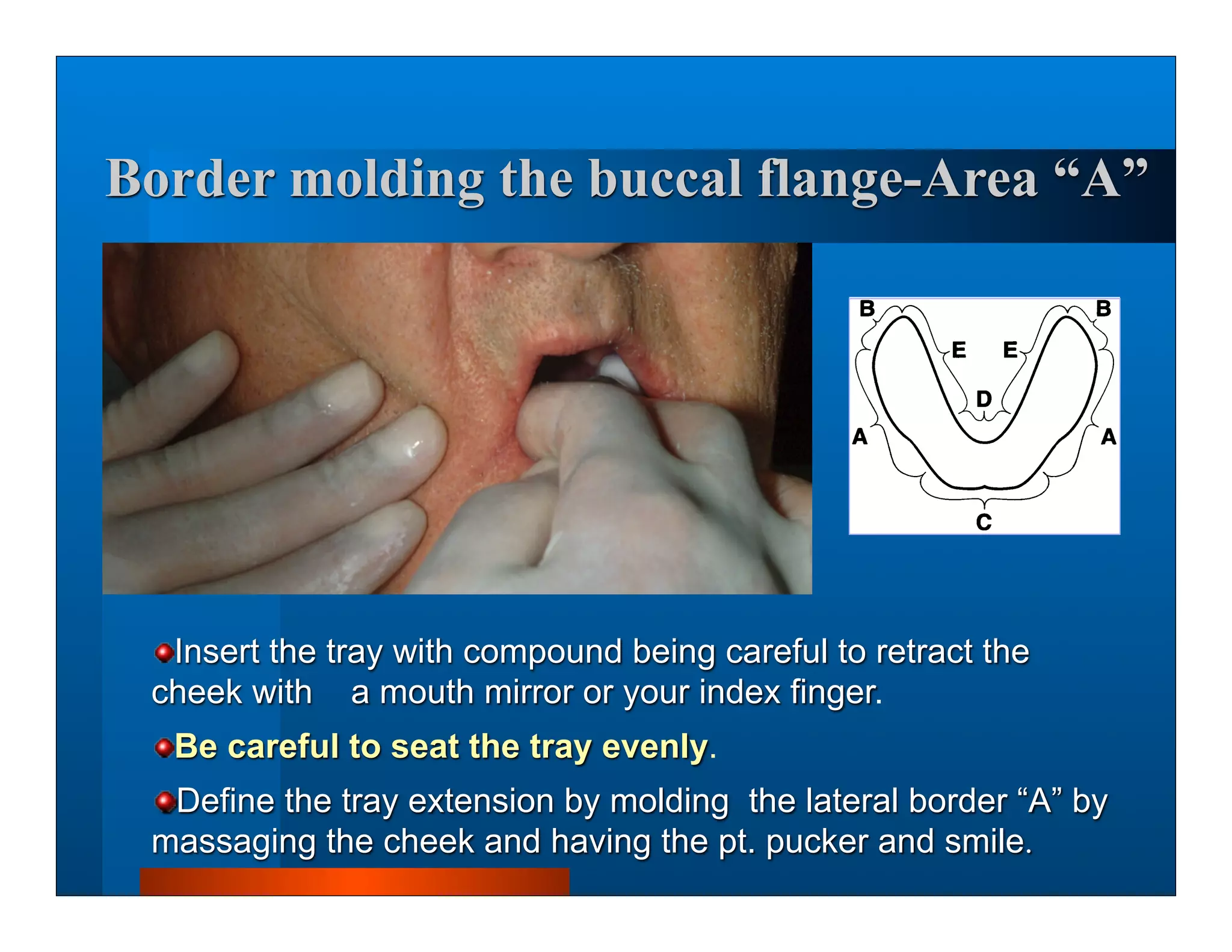 Complete dentures 7. final impressions | PDF