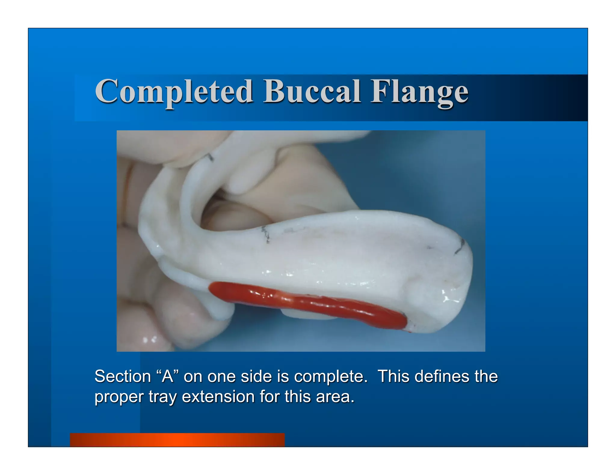 Complete dentures 7. final impressions | PDF