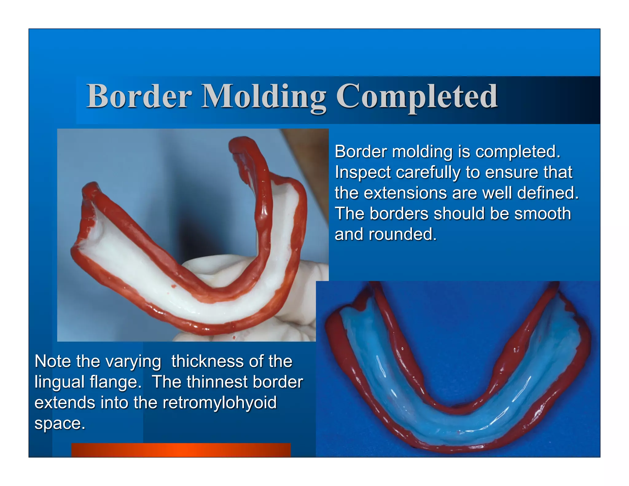 Complete dentures 7. final impressions | PDF