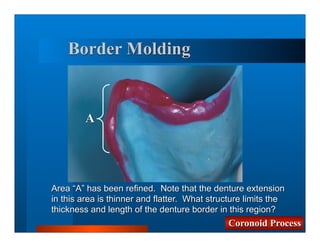 Complete dentures 7. final impressions | PDF