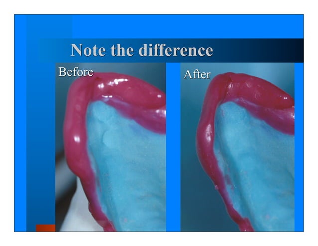 Complete dentures 7. final impressions | PDF