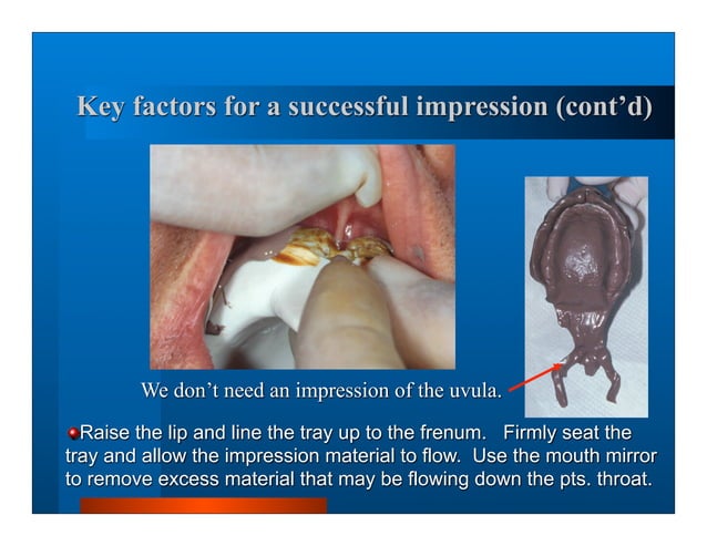 Complete dentures 7. final impressions | PDF