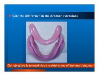 Complete dentures 7. final impressions | PDF