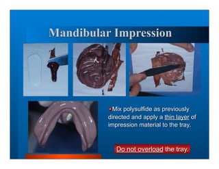 Complete dentures 7. final impressions | PDF