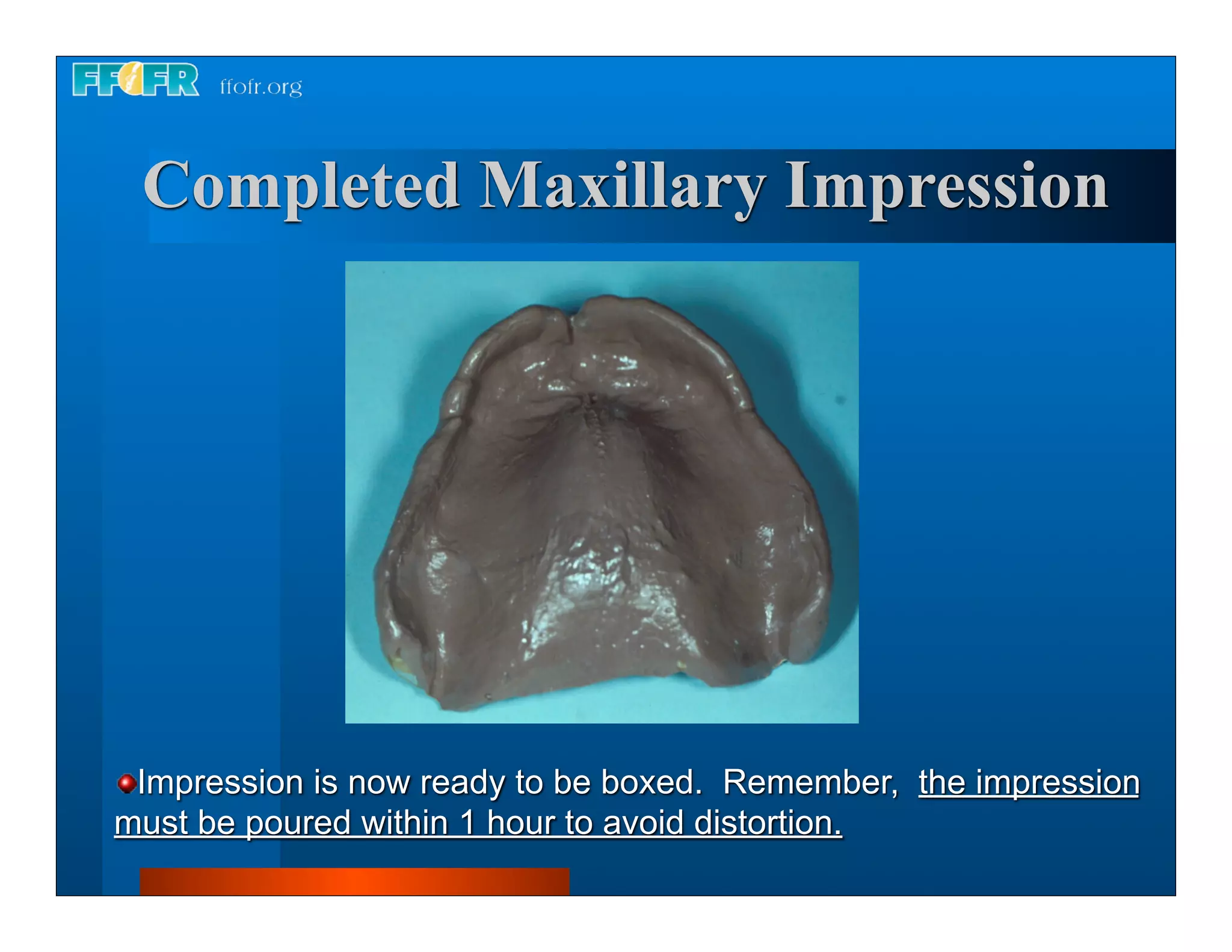 Complete dentures 7. final impressions | PDF