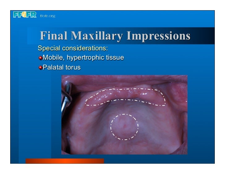 Complete dentures 7. final impressions