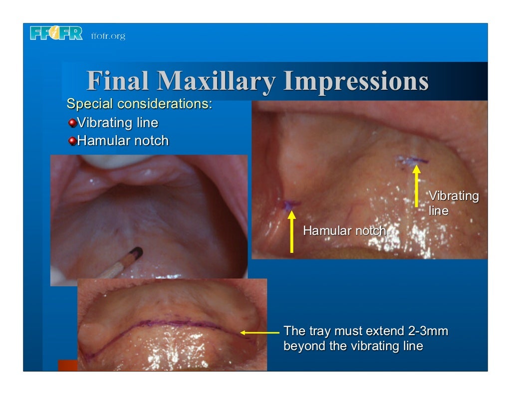 Complete dentures 7. final impressions