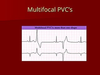 complete ECG interpretation presentation.ppt