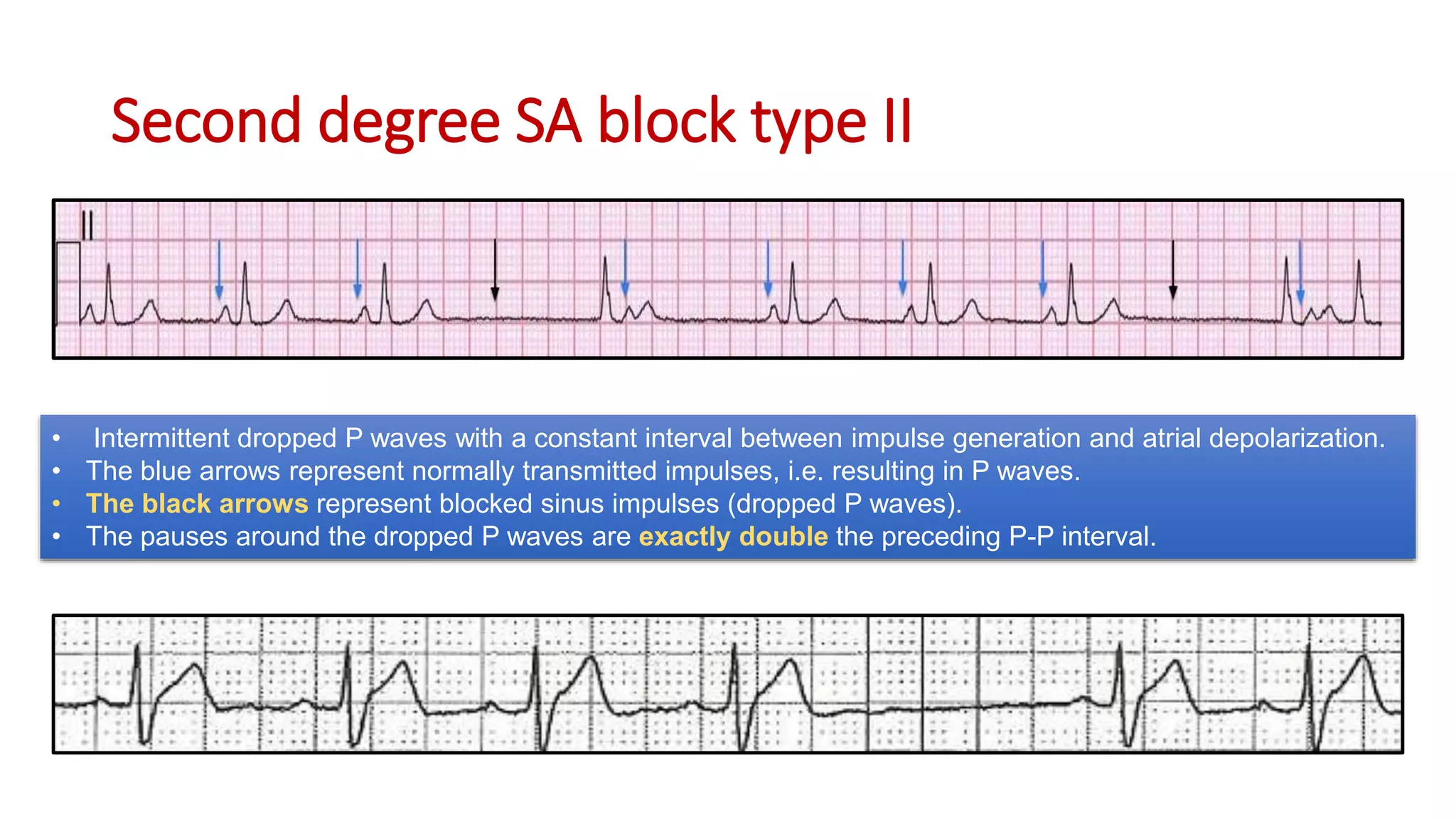 Complete EKG Interpretation Course | PPTX