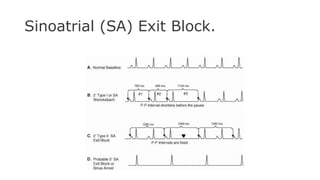 COMPLETE ATRIOVENTRICULAR HEART BLOCK.pptx