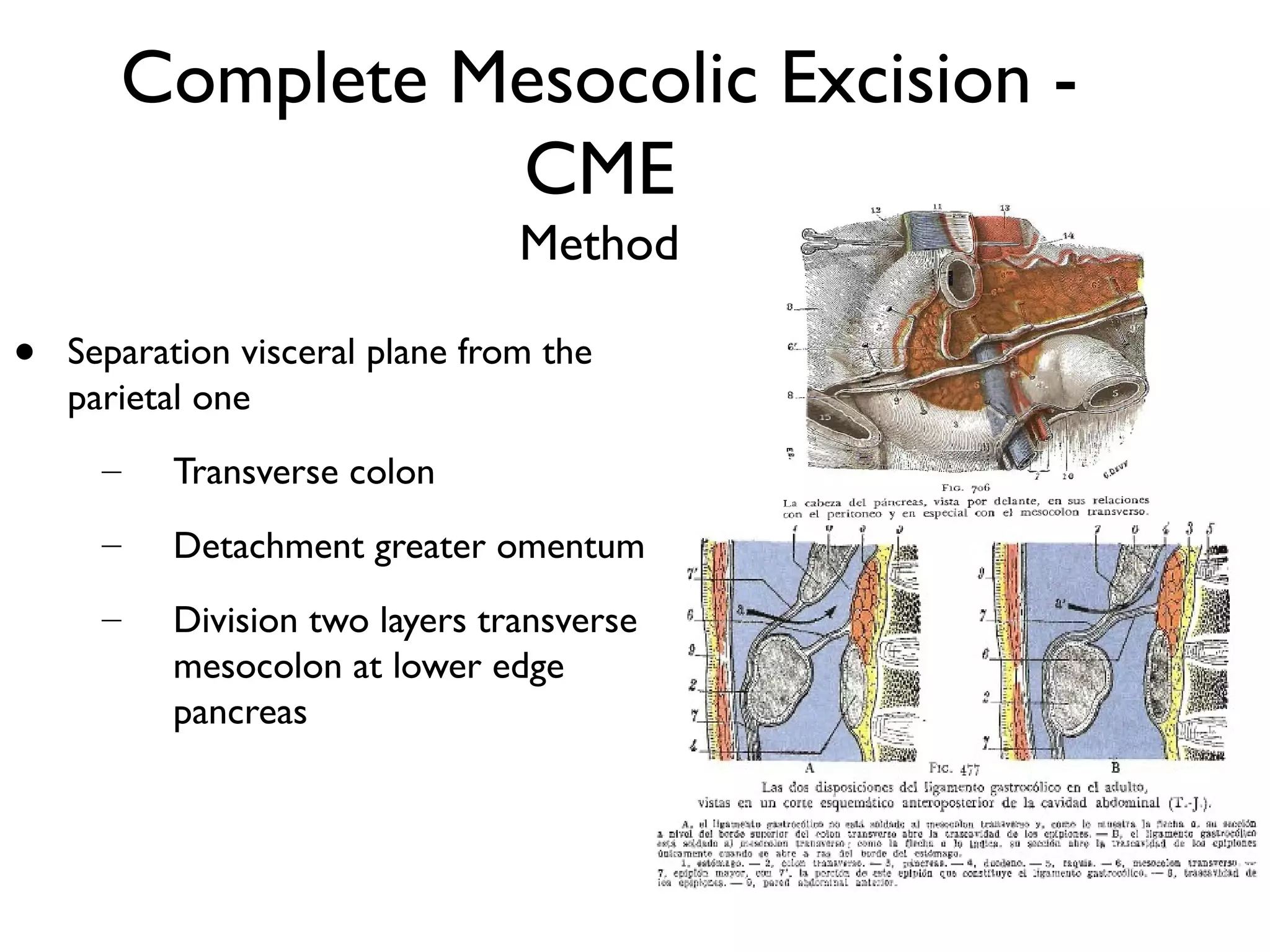 Complete mesocolic excision | PPT