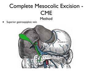 Complete mesocolic excision | PPT