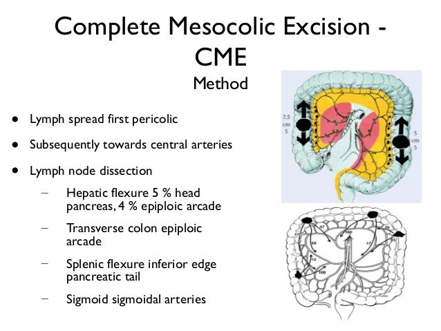 Complete mesocolic excision
