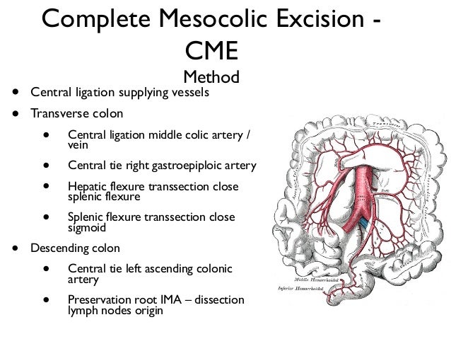 Complete mesocolic excision