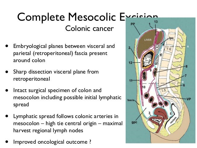 Complete mesocolic excision