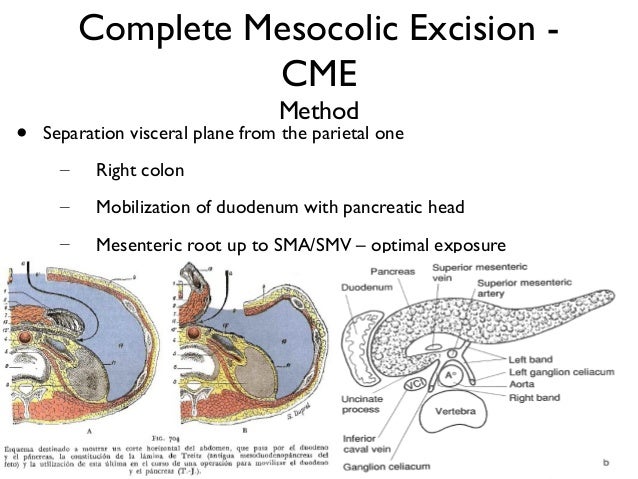Complete mesocolic excision