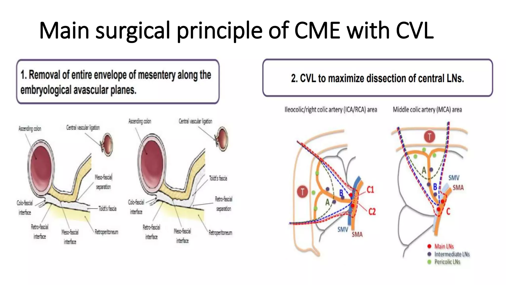 Complete mesocolic excision (CME) Vs D2.pptx