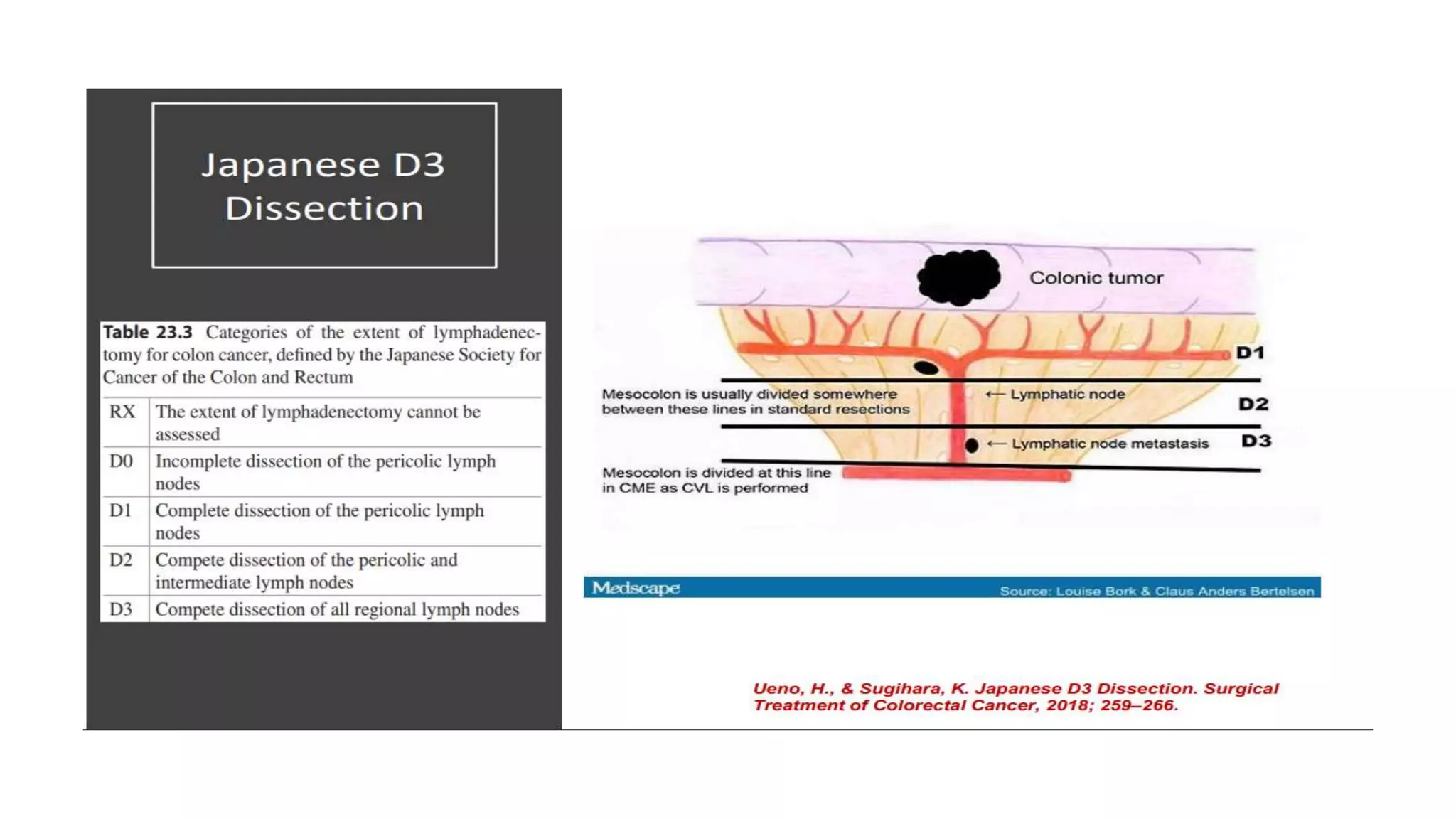 Complete mesocolic excision (CME) Vs D2.pptx