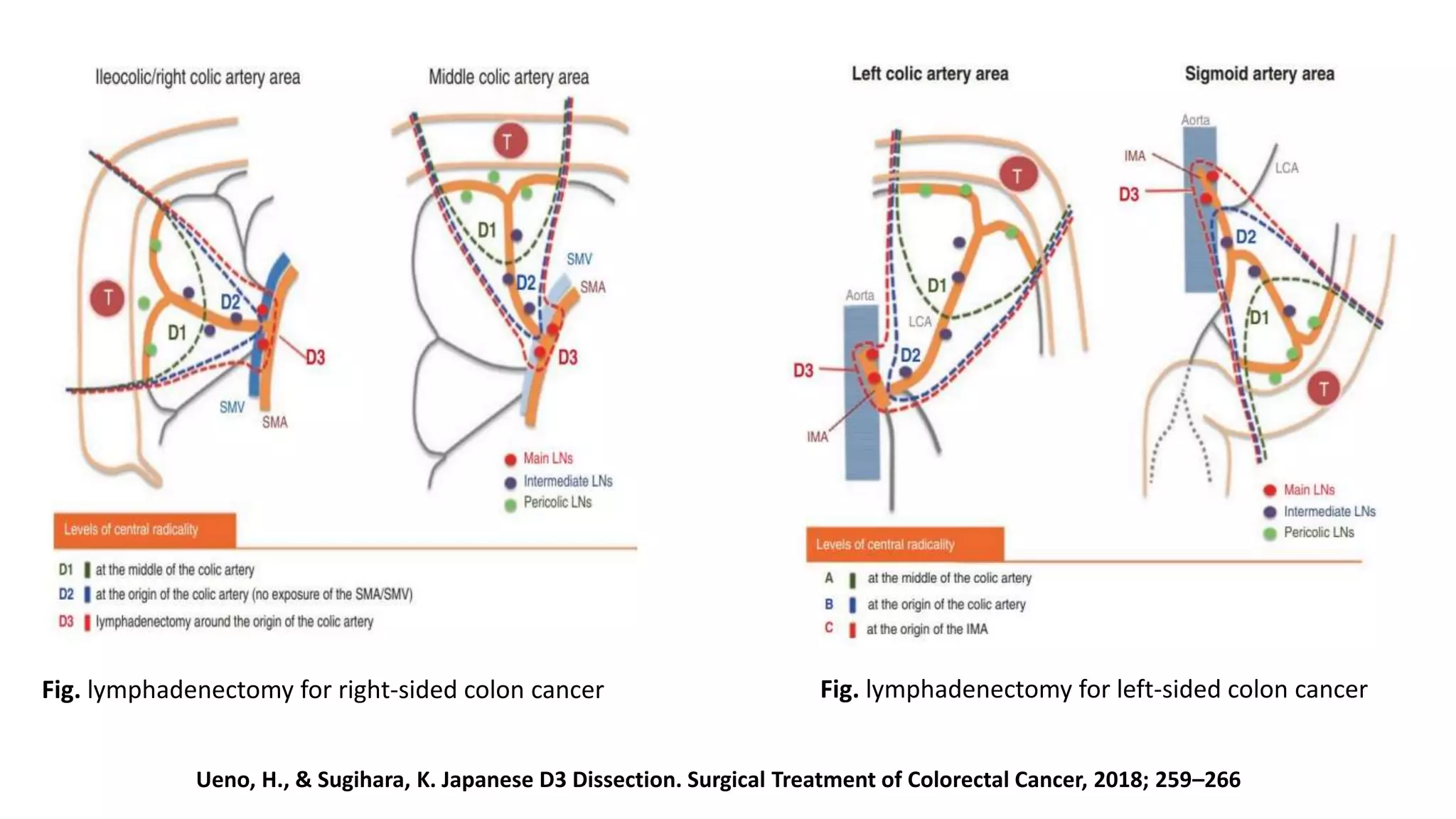 Complete Mesocolic Excision Cme Vs D2 Pptx