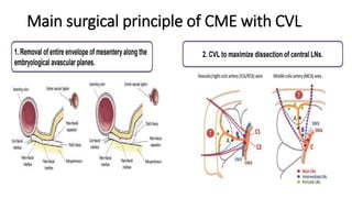 Complete mesocolic excision (CME) Vs D2.pptx