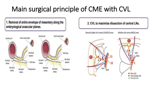 Complete mesocolic excision (CME) Vs D2.pptx | Surgery | Medical Health